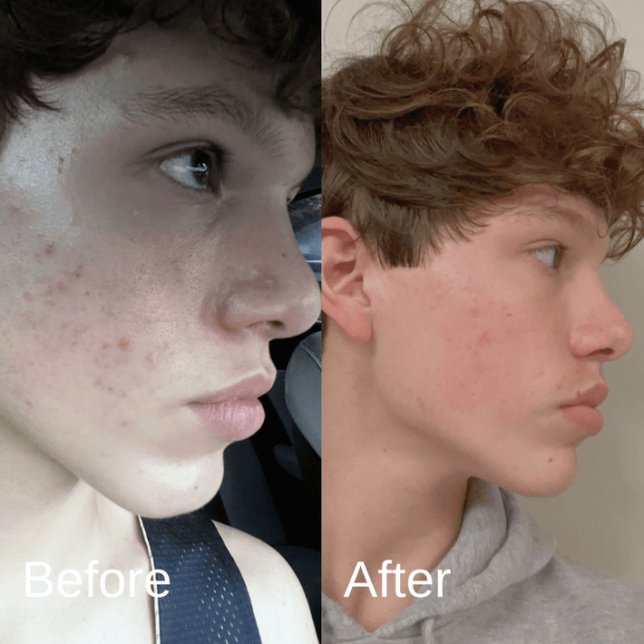 Shield - Acne System for Men
