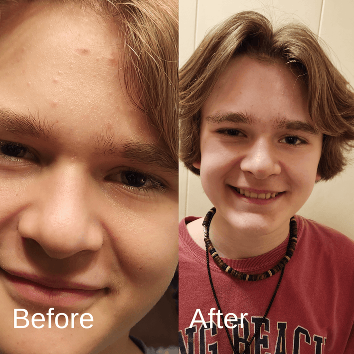 Shield System - 10 Reasons I trust Shield for Clear Skin