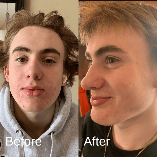 Shield - Acne System for Men