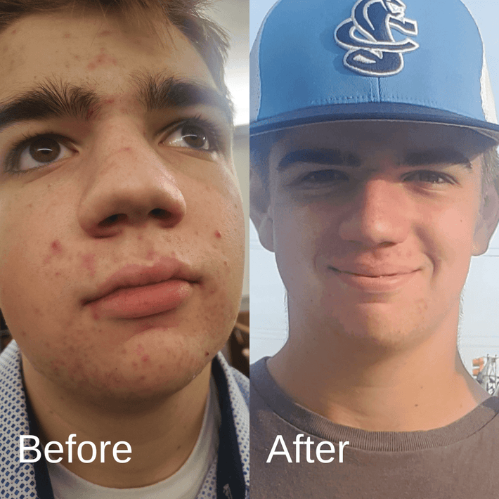 Shield System - 10 Reasons I trust Shield for Clear Skin